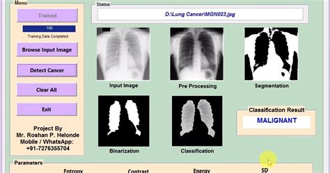 Matlab Code For Lung Cancer Detection Using Image Processing Full Matlab Project Code