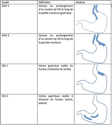 Classification Des Varices Gastriques Et Cardio Tubérositaires Sfed