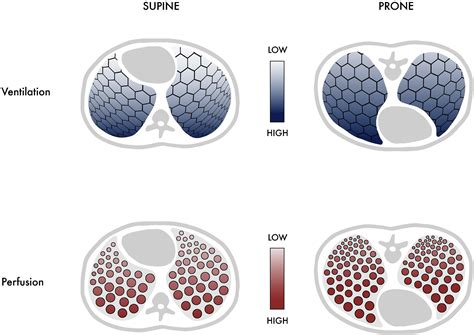 Prone Positioning For Acute Hypoxemic Respiratory Failure And Ards Chest