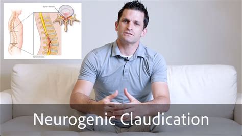 Neurogenic Claudication Spinal Stenosis Youtube