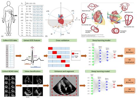 Deep Learning Based Approaches For Myocardial Infarction Detection A
