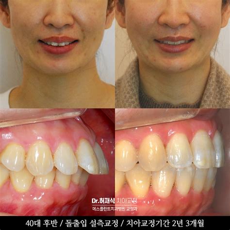 40대 50대 치아교정 고민하는 이유 성인교정 핵심 포인트 교정전문의 칼럼 에스플란트치과병원 교정과
