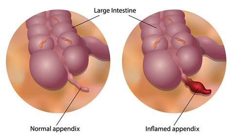 Appendicectomy Brisbane Sunnybank Surgical Group Brisbane General Surgery Group