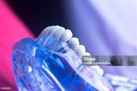 치과 의사 치과 치아 교육 각 치아 잇 몸 루트 임 플 란 트 부패 패 및에 나 멜을 보여주는 모델 3차원 형태에 대한 스톡 사진 및 기타 이미지 Istock