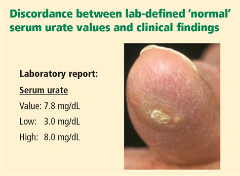 Clinical Manifestations Of Hyperuricemia And Gout Mdedge