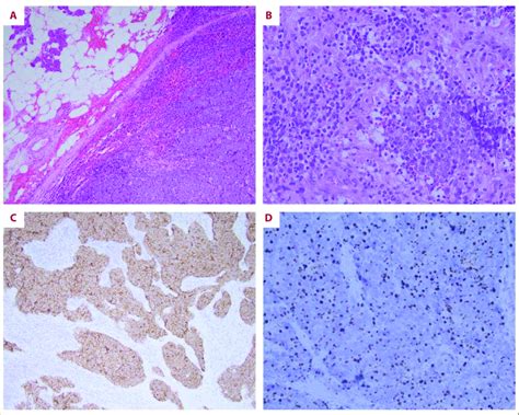 A Tumor Cells Located Within The Encapsulated Lymph Node Tissue Some Download Scientific