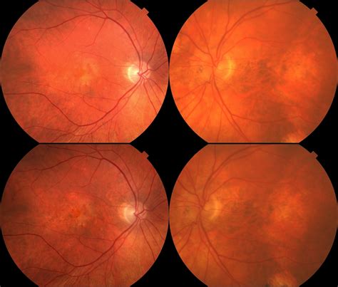 Color Fundus Photography Eye Pix