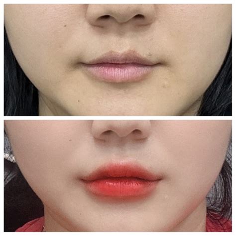 압구정역피부과 에피티크 입술필러 내돈내산 후기 전후 네이버 블로그