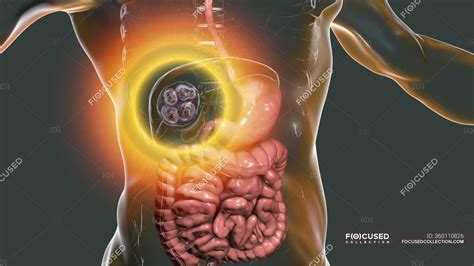 Hydatid Disease In Liver Caused By Larvae Of Parasitic Tapeworm