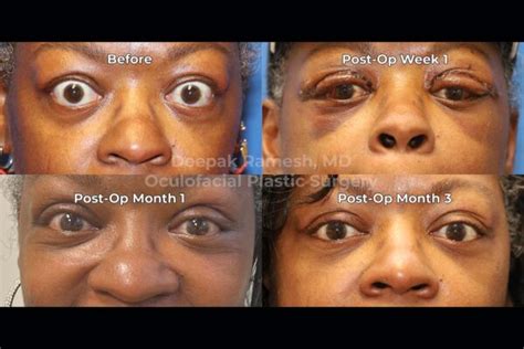 Recovery From Orbital Surgery New Jersey Center For Eye And Facial Plastics