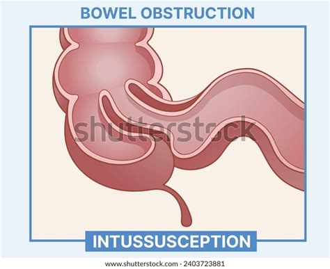 Bowel Obstruction Intussusception Healthcare Illustration Vector Stock