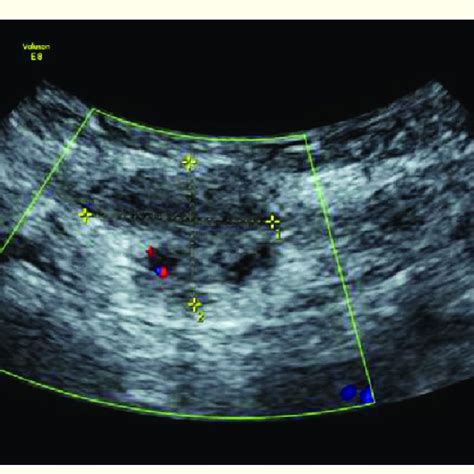 Ultrasound Image Of Endometrioma Download Scientific Diagram