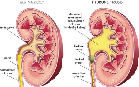 Hydronephrosis Care And Treatment Urologic Surgery Of Nwi