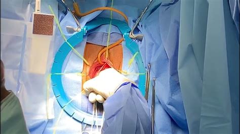 Native Tissue Rectocele Repair By Dr Christopher Hollowell Youtube