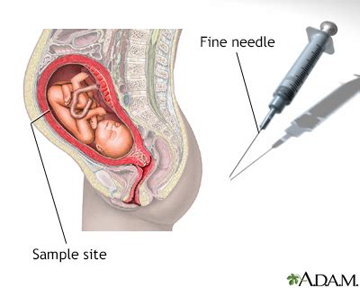 Amniocentesis Information Mount Sinai New York