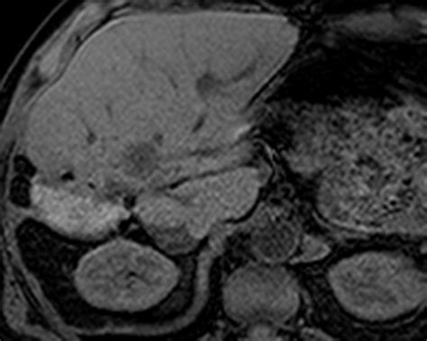 Liver Atlas Diagnosis Metastasis Cholangiocarcinoma