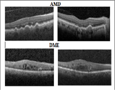 Figure 4 From A Review On Recent Work On Oct Image Classification For Disease Detection