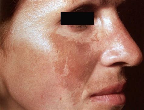 Skin Discoloration Causes And Dark Or White Skin Discoloration Treatment