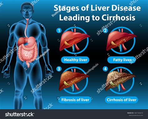 Stages Liver Disease Leading Cirrhosis Illustration เวกเตอร์สต็อก
