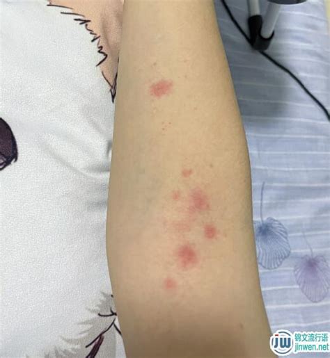 跳蚤咬的包和疤痕多久能消下去？跳蚤咬的红疙瘩图片 娱乐圈热词 锦文网络流行语