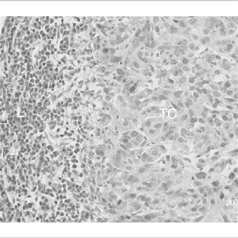 Mediastinal Lymph Node Metastasis From An Orthotopic Lung Tumor