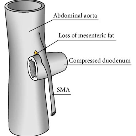 Contrast Ct Of The Abdomen Showing The Distance Between Aorta And Sma