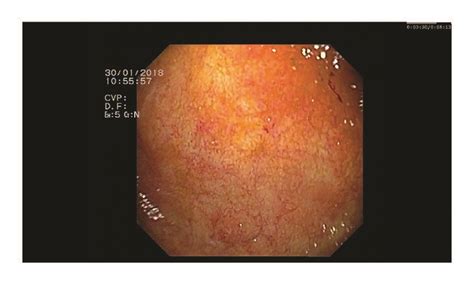 Representative Endoscopy Images A Initial Ileoscopy Showing