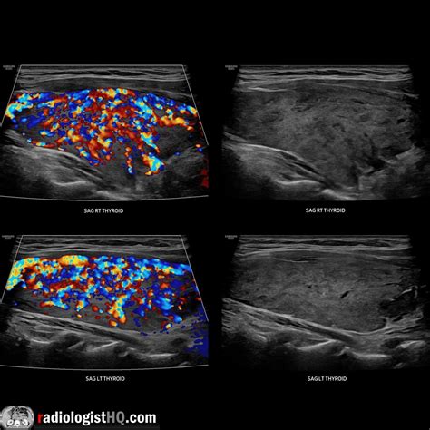Enlarged Thyroid Ultrasound Image