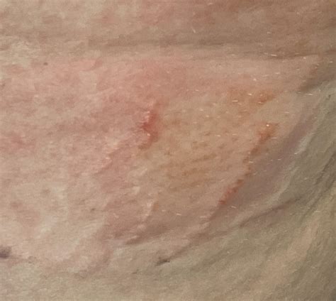 Rash Solution For Those Also Allergic To Skin Tac R Dexcom