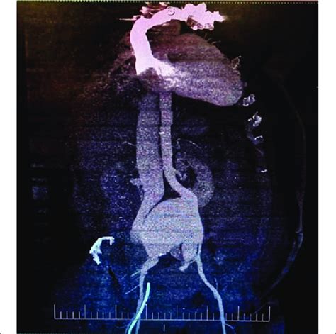 Ct Aortogram Showing Large Infrarenal Abdominal Aortic Aneurysm Download Scientific Diagram