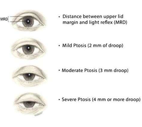 Droopy Eyelids Ptosis Causes And Treatment In Singapore