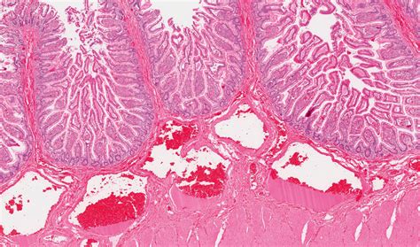 Vascular Pathology Of The Gastrointestinal Tract Diagnostic