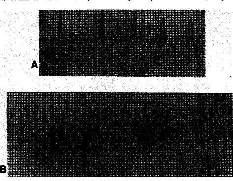 Figure 2 From Intermittent Left Bundle Branch Block In The Athletic Heart Syndrome Semantic