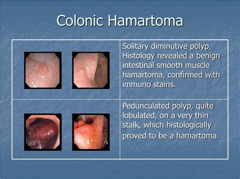 Polyps In Rectosigmoid Colon At Felipa Hunter Blog