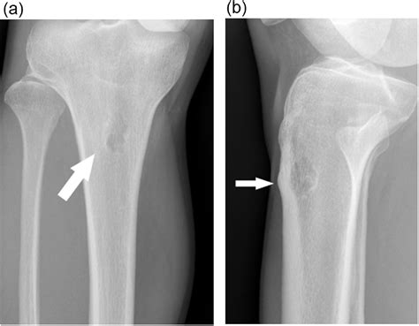 Tibial Cortical Lesions A Multimodality Pictorial Review European Journal Of Radiology