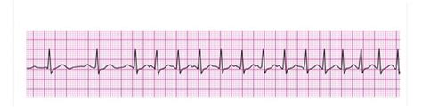 Ekg Identification For Acls Flashcards Quizlet