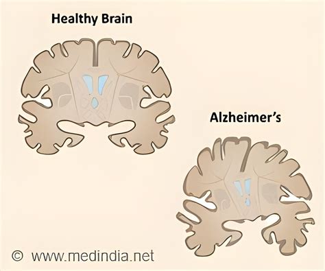 New Ai Tool Spots Cognitive Decline