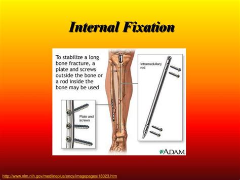 Ppt Fracture Fixation Internal And External Powerpoint Presentation Id 333030
