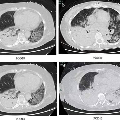 Pulmonary Imaging Showed Pulmonary Consolidation A And B Are The Day Download Scientific