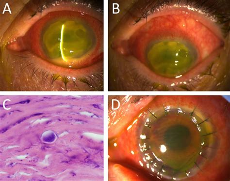 Acanthamoeba Scleral Abscess Reoccurring After Penetrating Keratoplasty