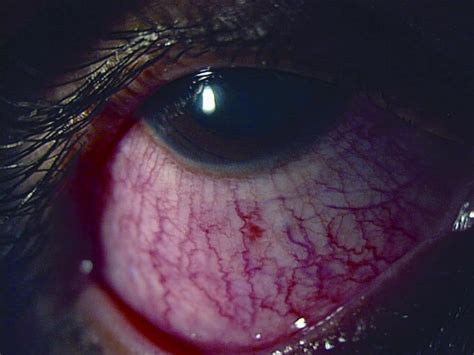 Filescleritis Eyewiki