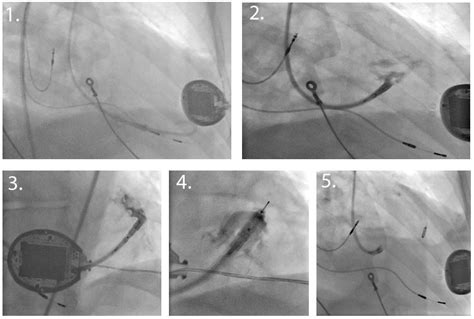 CASE REPORT WiSE CRT Technology A Feasible And Effective Alternative To Conventional CRT