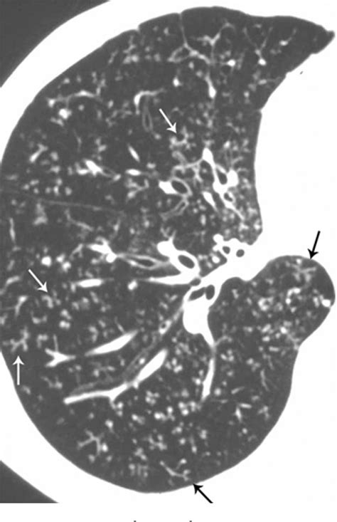 Figure 11 From A High Resolution Ct Scan Diagnostic Algorithm Semantic Scholar