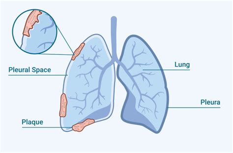 Mesothelioma Pleural Plaques Mesothelioma Guide