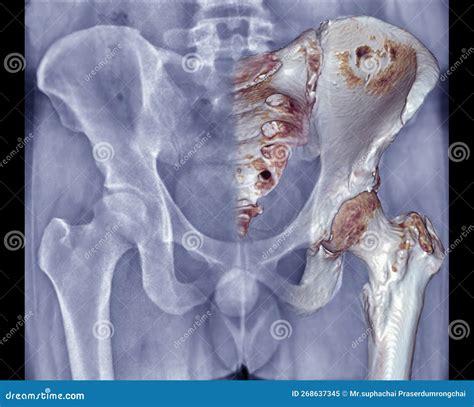 Xray Pelvic Bone Ap View With Fusion 3d Rendering Stock Illustration