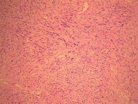 Large Retroperitoneal Leiomyosarcoma International Journal Of Recent Surgical And Medical Sciences