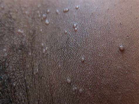 Bumps On Penis Common Causes And When To Seek Care