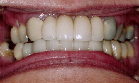 Facing Forward The Case Of The Maxillary Prosthesis Orthodontic
