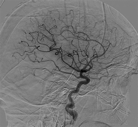 Distal Occlusion Thrombectomy With Solitaire™ X 3mm
