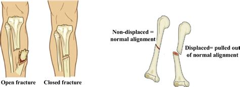 A Real Time Human Bone Fracture Detection And Classification From Multi Modal Images Using Deep